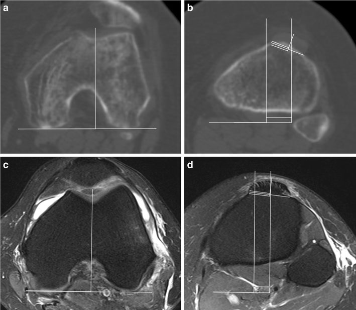 Are the osseous and tendinous-cartilaginous tibial tuberosity-trochlear ...