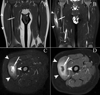 Vaccine-induced myositis with intramuscular sterile abscess formation ...