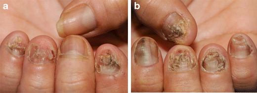 Sarcoidosis: radiographic manifestations in the nails and distal ...