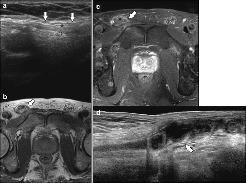 Sonographic evaluation of athletic pubalgia | SpringerLink