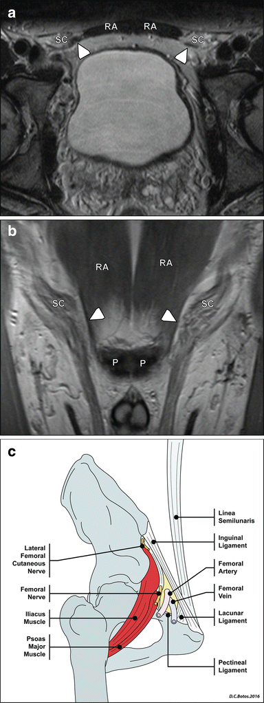 Sonographic evaluation of athletic pubalgia | SpringerLink