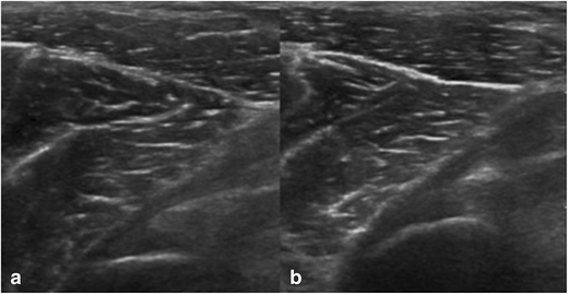 Imaging of rectus femoris proximal tendinopathies | SpringerLink