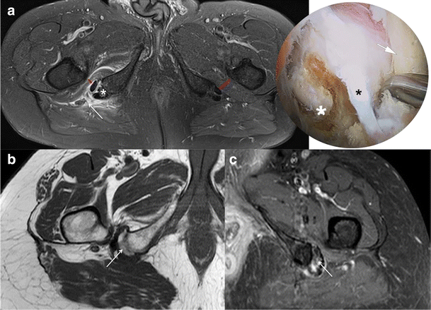 Evaluation and management of ischiofemoral impingement: a ...