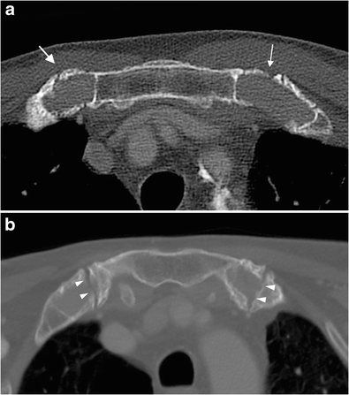 High-resolution CT of the sternoclavicular joint and first ...