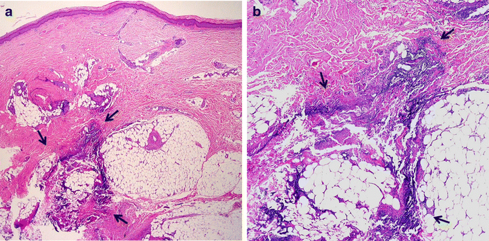 Pancreatitis, panniculitis, and polyarthritis (PPP) syndrome: MRI ...