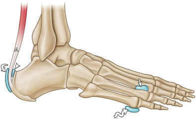 Ultrasound evaluation of bursae: anatomy and pathological appearances ...