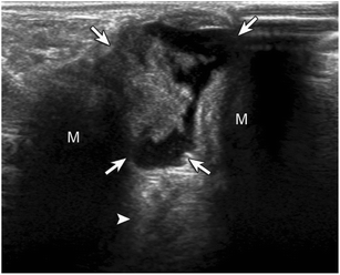 Ultrasound evaluation of bursae: anatomy and pathological appearances ...