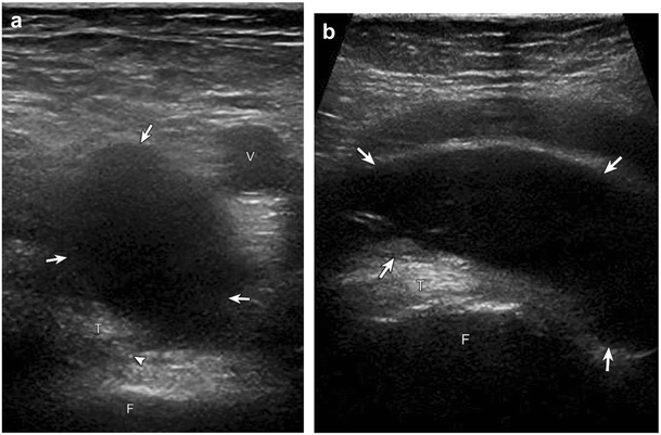 Ultrasound evaluation of bursae: anatomy and pathological appearances ...