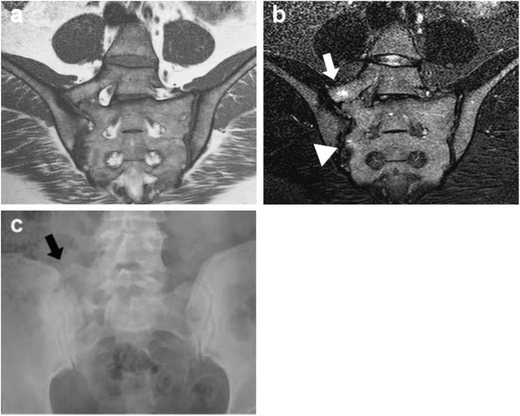 Prevalence and clinical significance of lumbosacral transitional ...