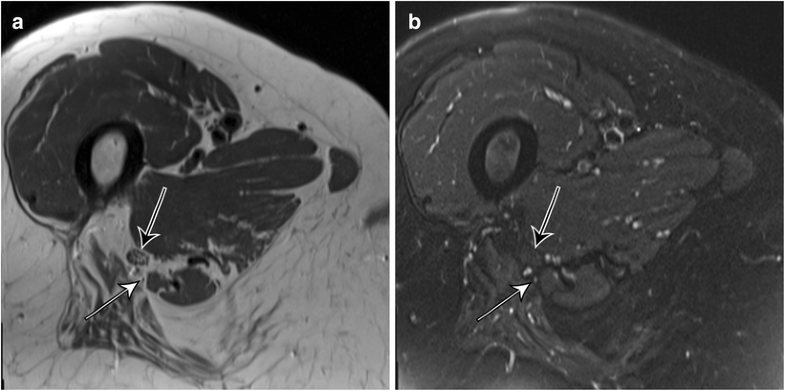 MRI-guided cryoablation of the posterior femoral cutaneous nerve for ...
