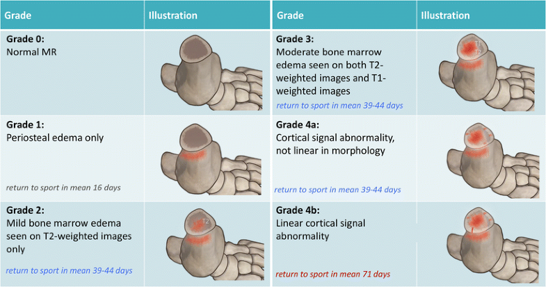 Stress fractures of the foot and ankle, part 2: site-specific etiology ...
