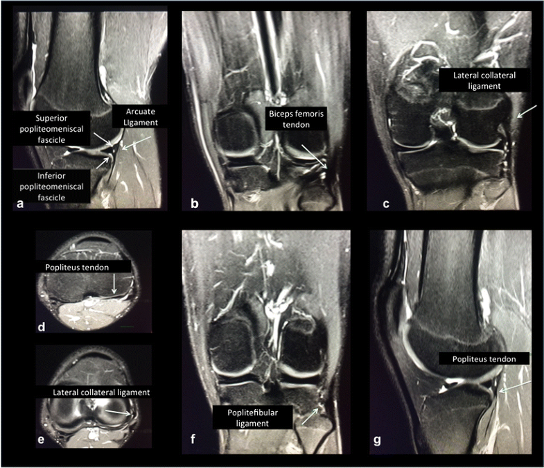 Incidence and MRI characterization of the spectrum of posterolateral ...