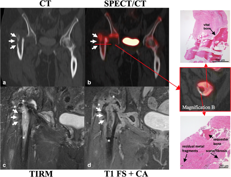Evaluation of bone viability in patients after girdlestone arthroplasty ...