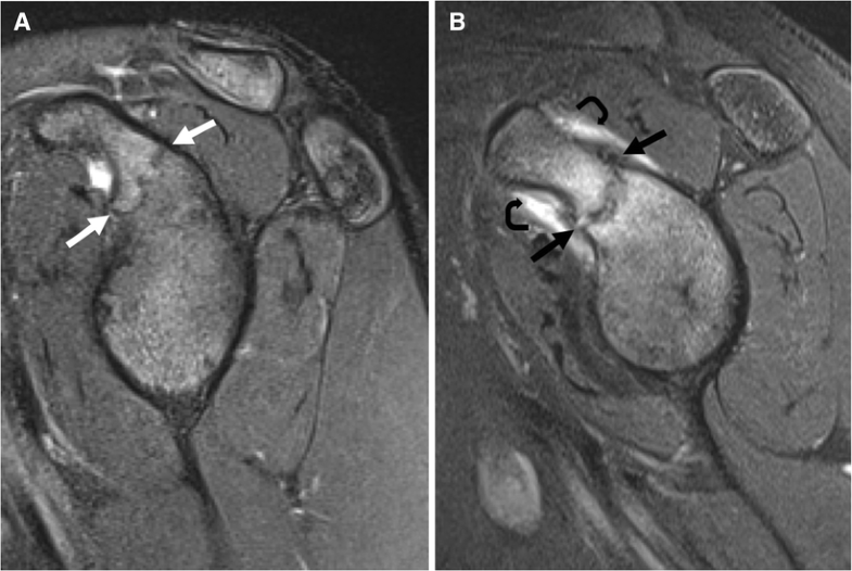 Growth plate injury at the base of the coracoid: MRI features ...