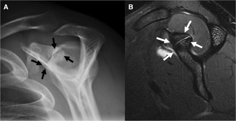 Growth plate injury at the base of the coracoid: MRI features ...