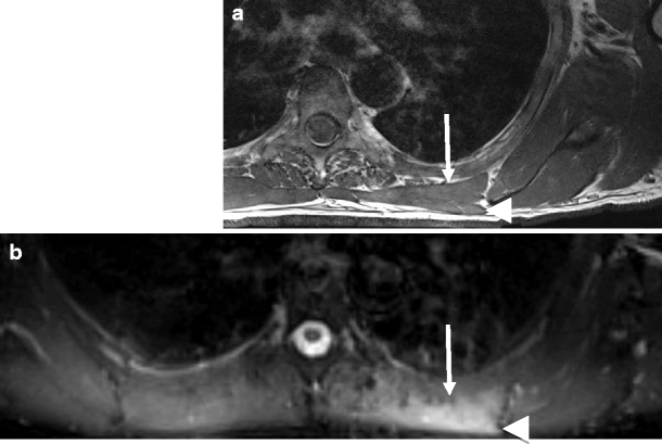 MR neurography (MRN) of the long thoracic nerve: retrospective review ...