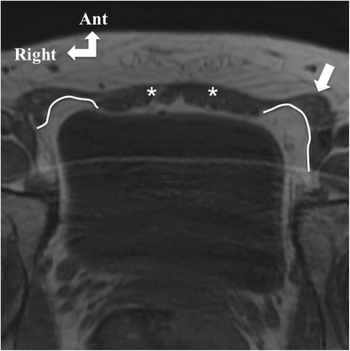 MRI in chronic groin pain: sequence diagnostic reliability compared to ...