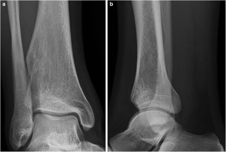Epiphyseal hyperplasia caused by an ectopic ossification center of the ...