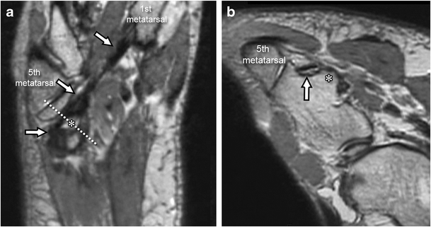 The location of the peroneus longus tendon in the cuboid groove ...