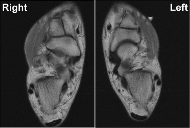 Bilateral painful foot masses | SpringerLink