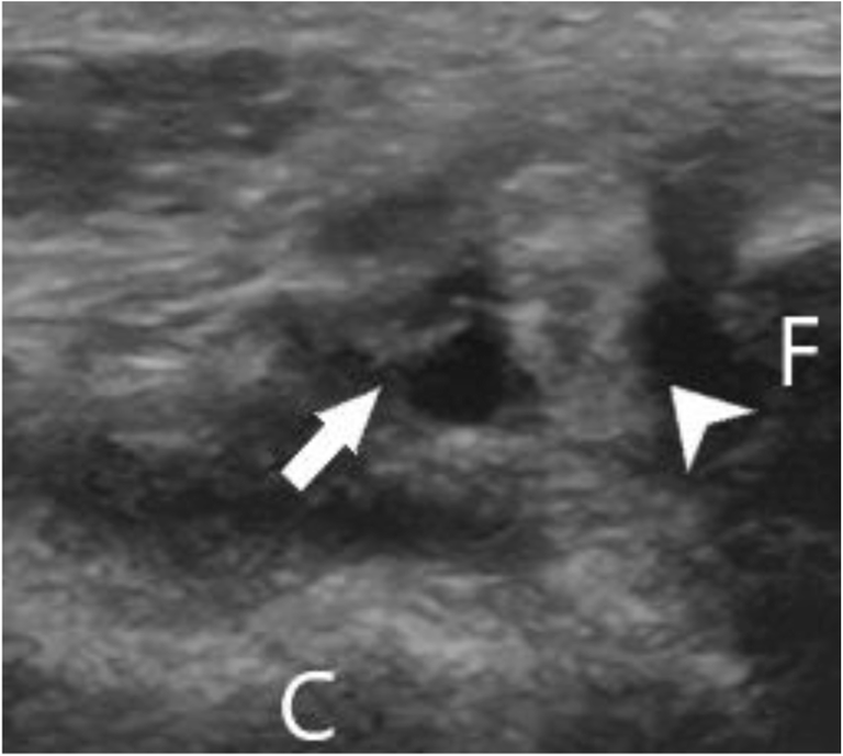 Sonographic and radiographic findings of posterior tibial tendon ...