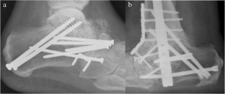 Sonographic and radiographic findings of posterior tibial tendon ...