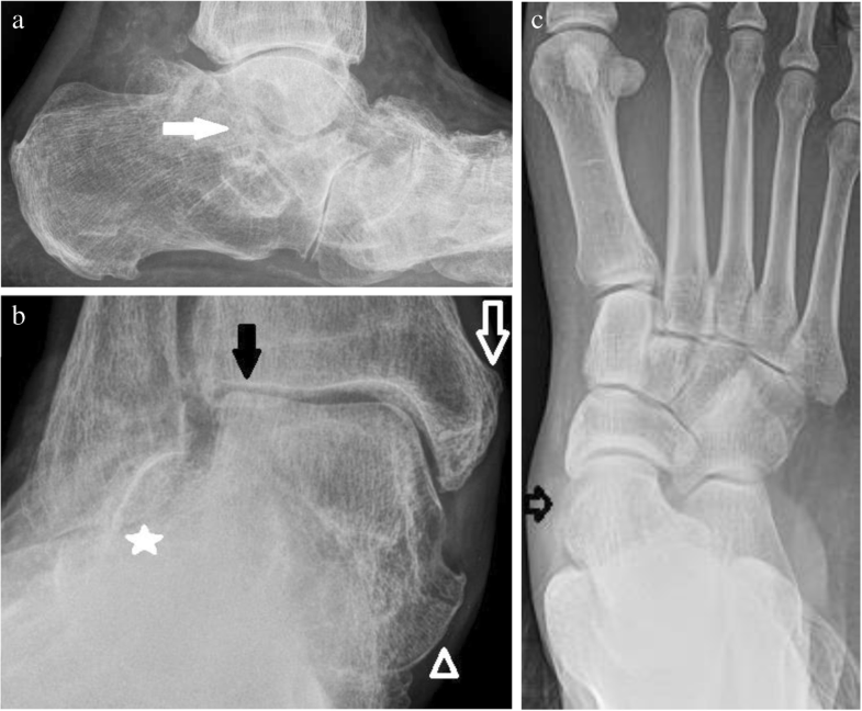 Sonographic and radiographic findings of posterior tibial tendon ...
