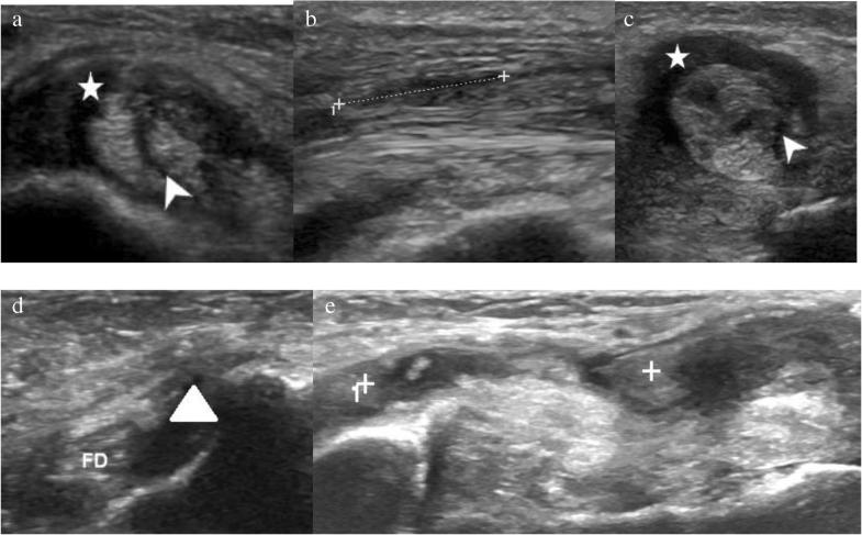 Sonographic and radiographic findings of posterior tibial tendon ...