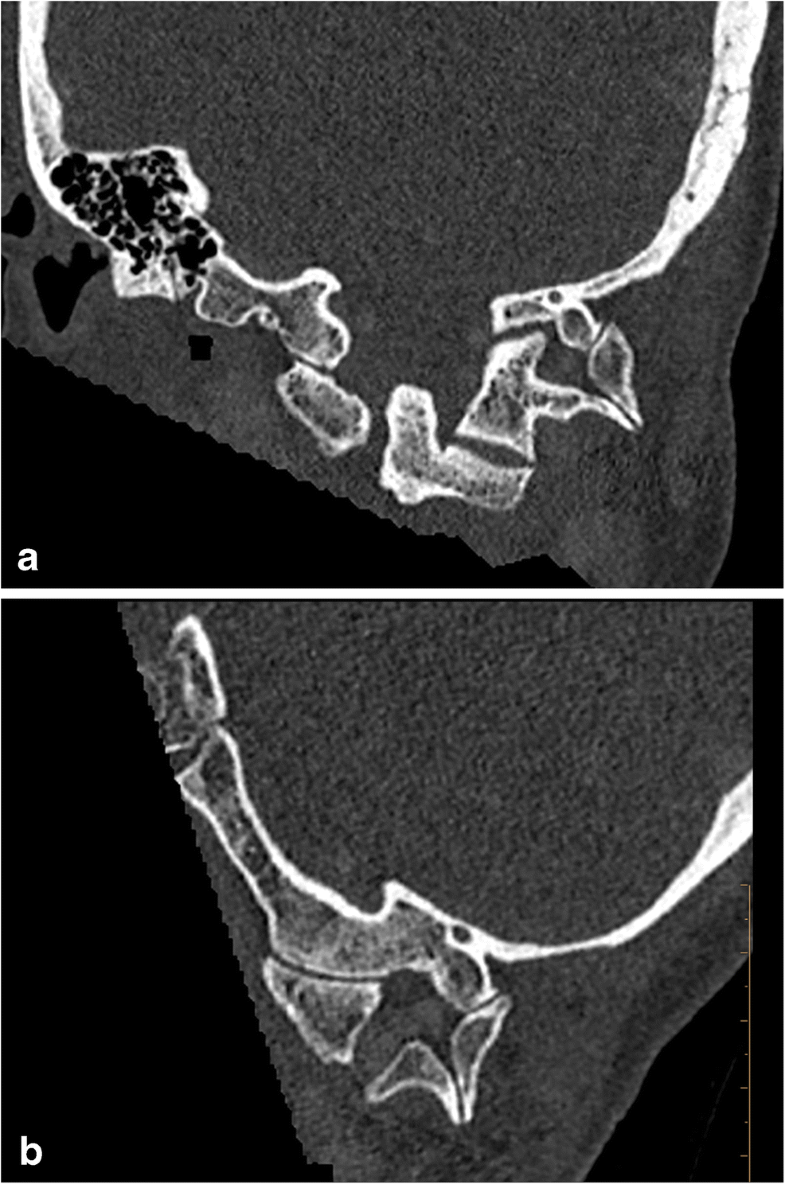 Post-auricular lump: CT diagnosis | SpringerLink