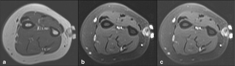 Multiple bilateral forearm nodules | SpringerLink