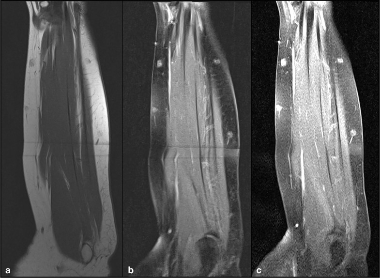 Multiple bilateral forearm nodules | SpringerLink