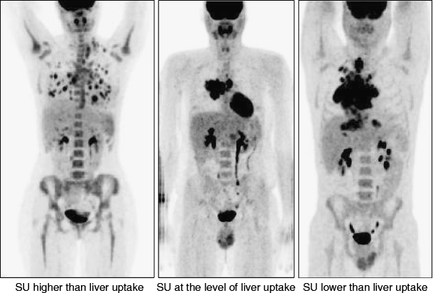 Analysis of 18F-FDG PET diffuse bone marrow uptake and splenic uptake ...