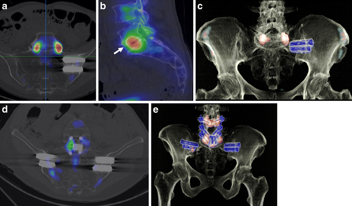 SPECT/CT for imaging of the spine and pelvis in clinical routine: a ...