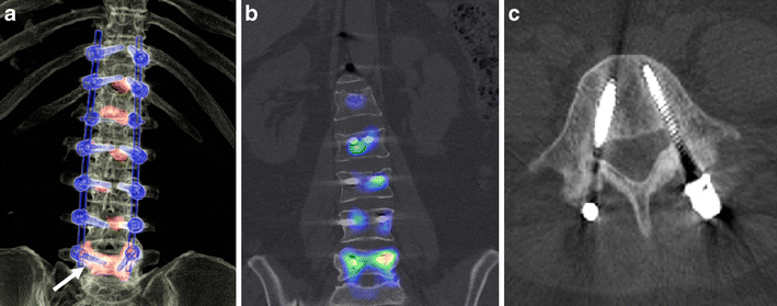 SPECT/CT for imaging of the spine and pelvis in clinical routine: a ...