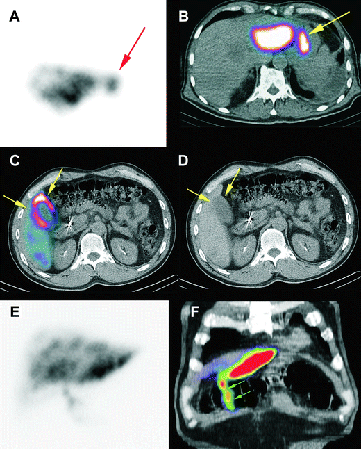 The role of SPECT/CT in radioembolization of liver tumours | SpringerLink