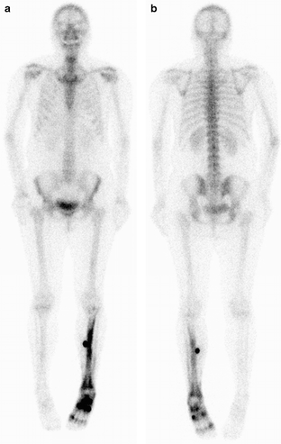 Injection artefact displaying “sock” pattern on bone scan: “glove” sign ...