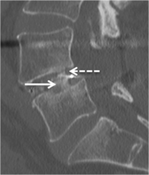 Pseudarthrosis after lumbar spinal fusion: the role of 18F-fluoride PET ...
