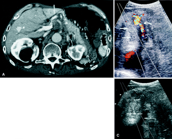 Percutaneous biopsy of periarterial soft tissue cuffs in the diagnosis ...