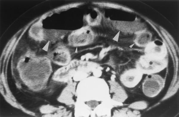 CT of small bowel ischemia | SpringerLink