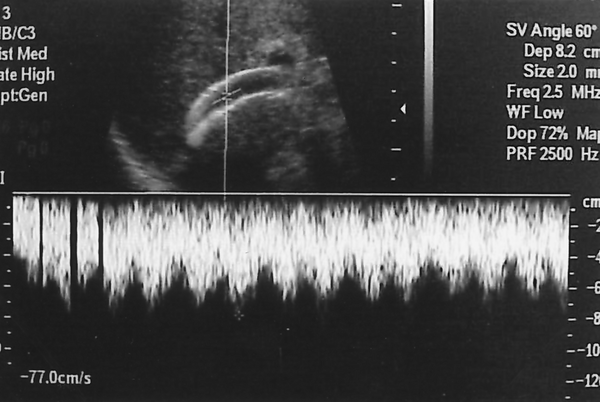 Doppler ultrasound for TIPS: does it work? | SpringerLink