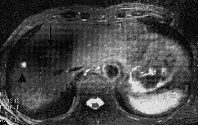 MRI findings of primary biliary cirrhosis: correlation with Scheuer ...