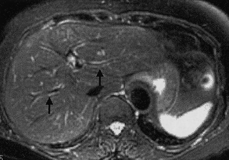 MRI findings of primary biliary cirrhosis: correlation with Scheuer ...