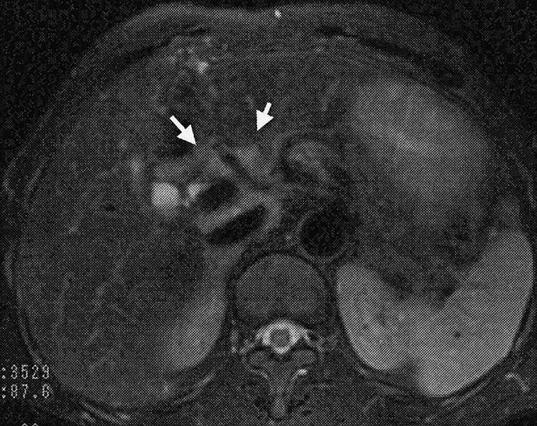 MRI findings of primary biliary cirrhosis: correlation with Scheuer ...