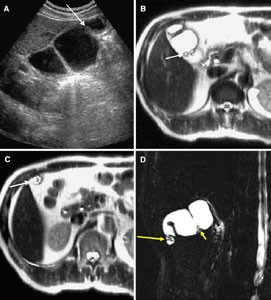 Gallbladder adenomyomatosis: imaging findings | SpringerLink