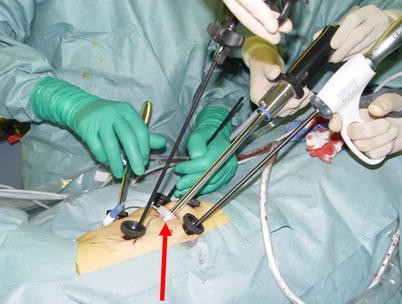 Virtual CT thoracoscopy: preoperative simulation for thoracoscopic ...