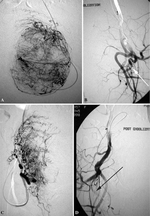 Update on uterine artery embolization for symptomatic fibroid disease ...