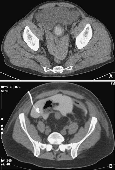 Incidence and imaging appearance of urethrovesical anastomotic urinary ...