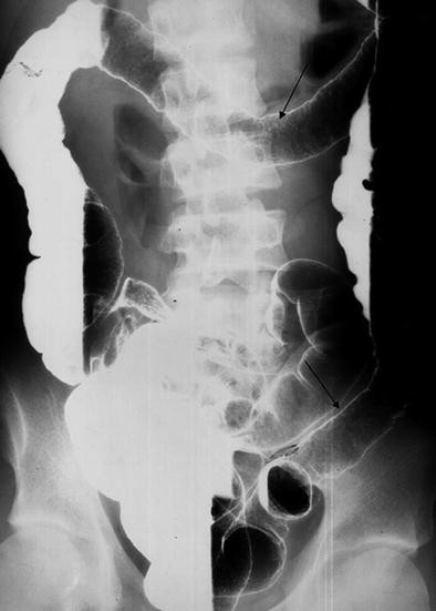 Intestinal parasitic infection | SpringerLink