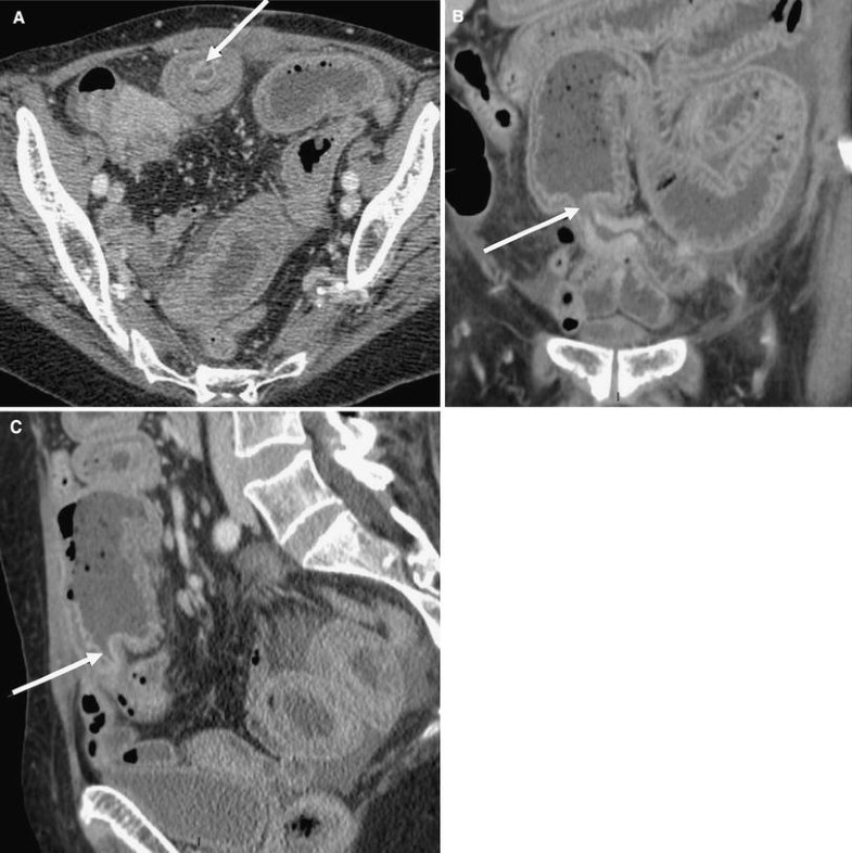 Location of the transition zone in CT of small-bowel obstruction: added ...