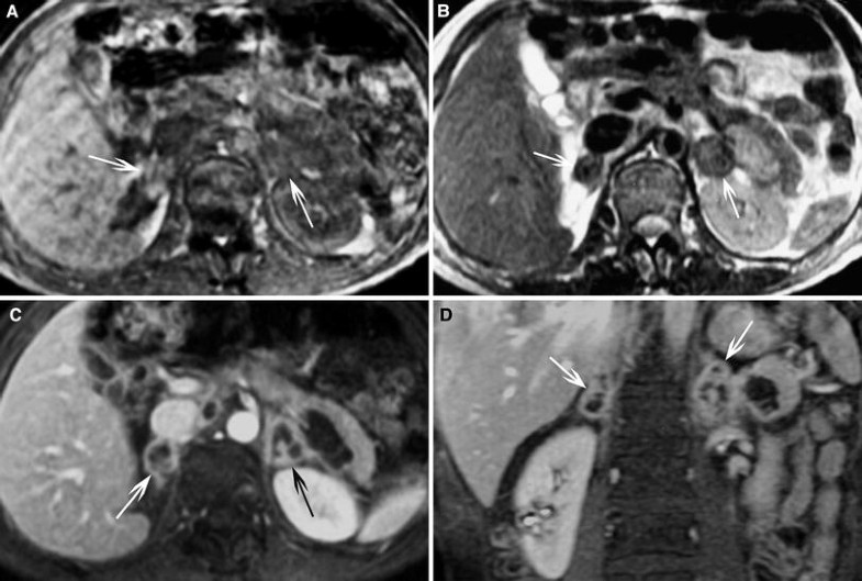 Addison’s disease due to adrenal tuberculosis: MRI features | SpringerLink